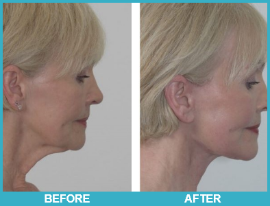 Try ACP 5th Gen Lifting Treatment Melbourne Now! | Perfect Laser Clinics