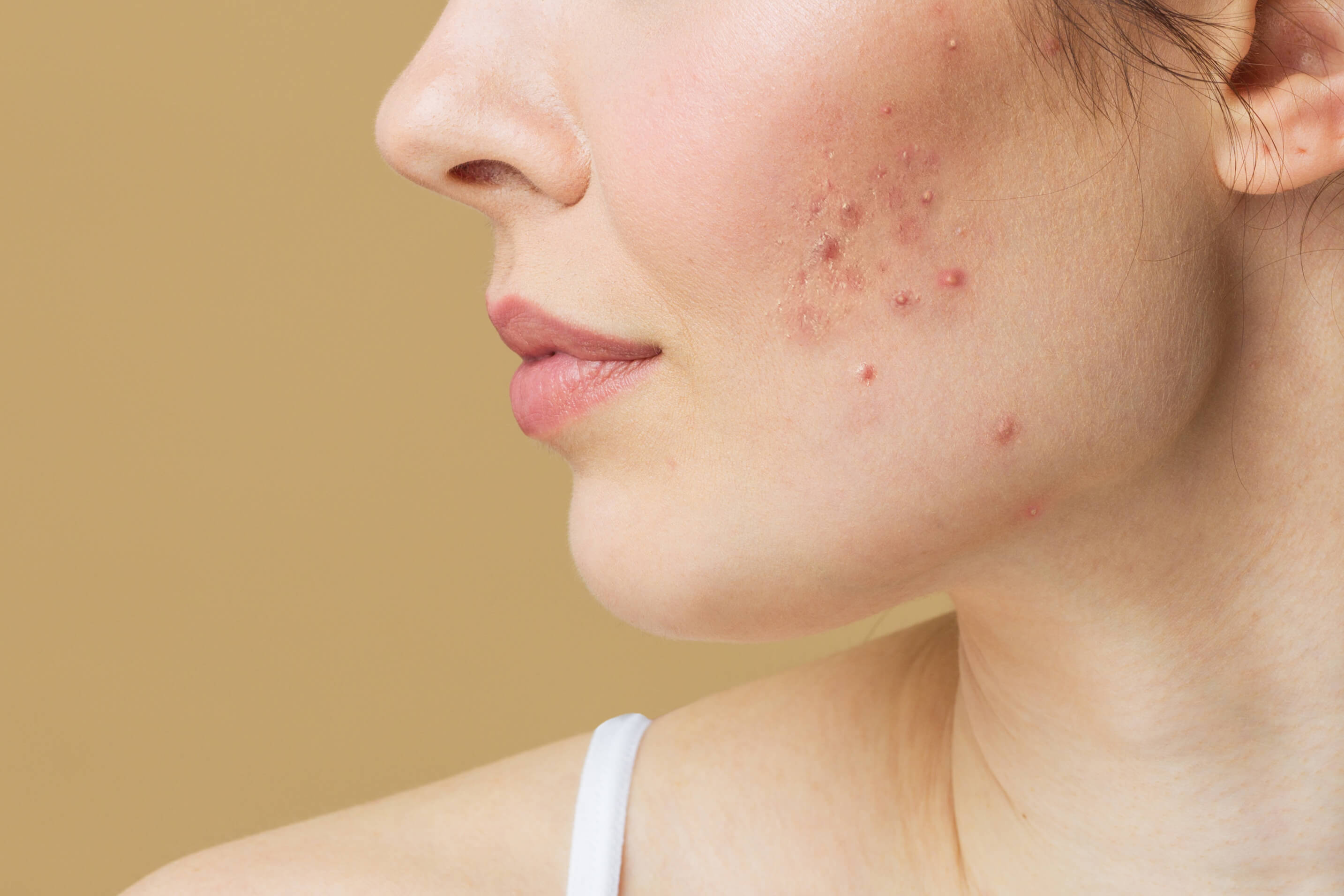 Signature Acne Treatment Get Perfect Skin Perfect Laser Clinics Signature Acne Treatment Get Perfect Skin Perfect Laser Clinics